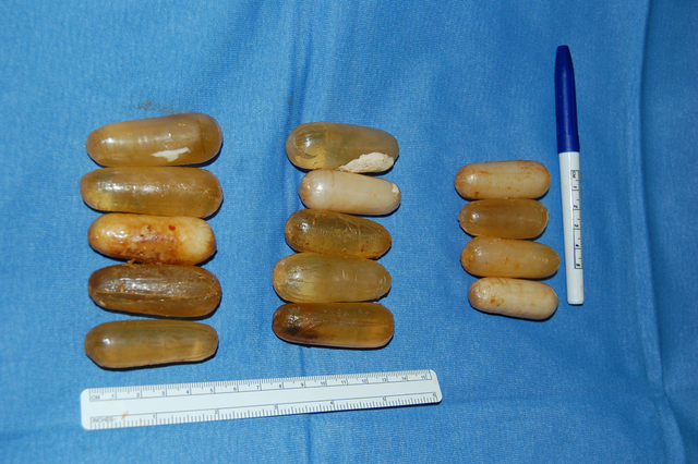 Sindrome da trasporto intracorporeo di droga - The body packer syndrome ...